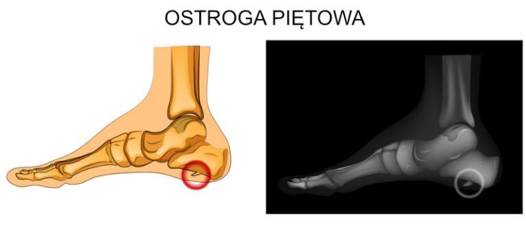 Entezopatia – przyczyny, objawy, leczenie
