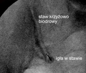 Zapalenie stawu krzyżowo biodrowego – objawy, ból, testy, blokada